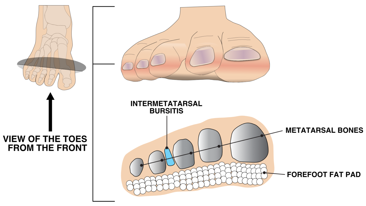 Ball of Foot and Toe Pain – NHS Forth Valley