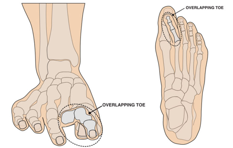 Ball of Foot and Toe Pain – NHS Forth Valley