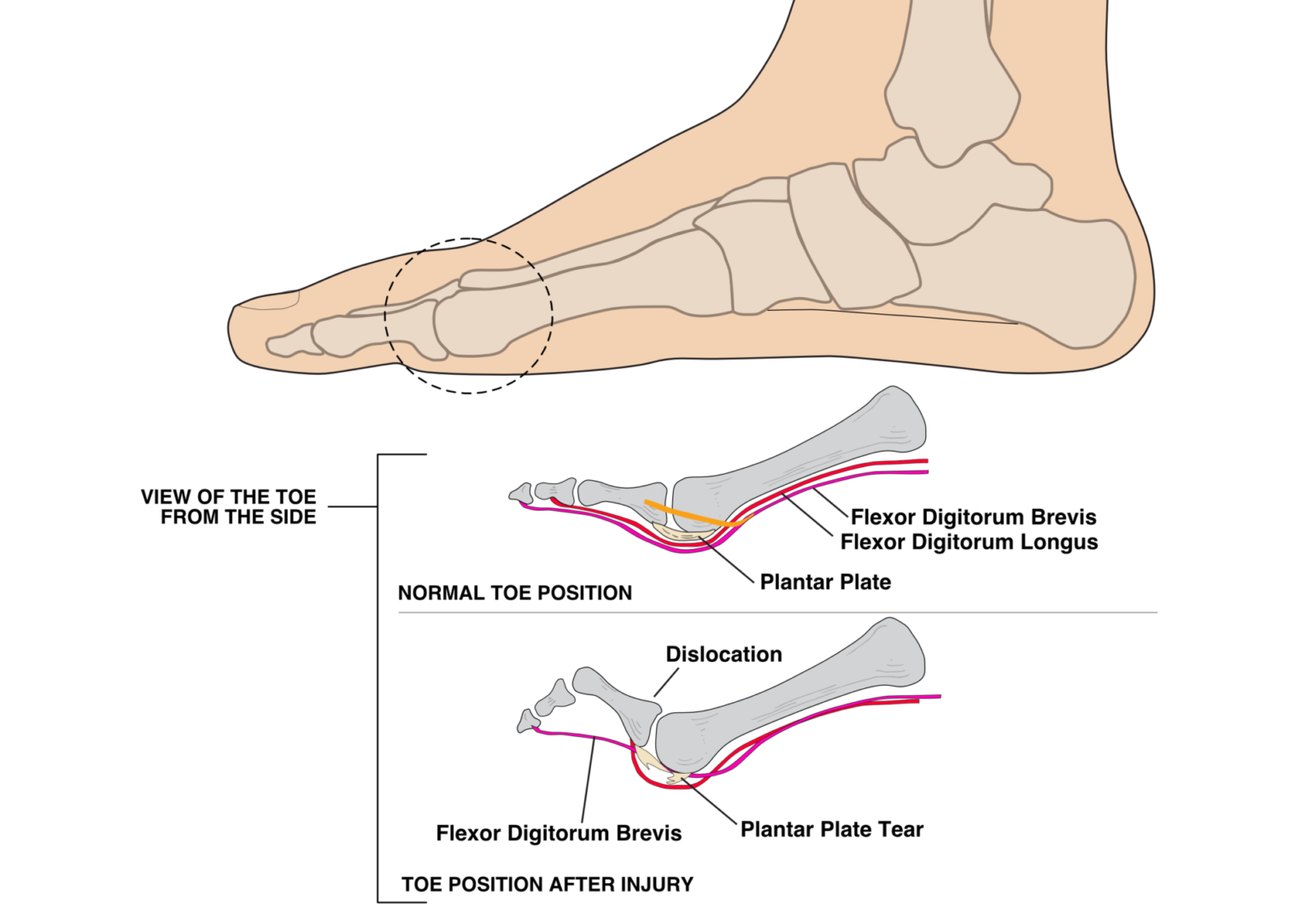 Ball of Foot and Toe Pain – NHS Forth Valley