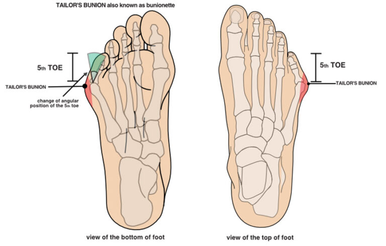 Ball of Foot and Toe Pain – NHS Forth Valley