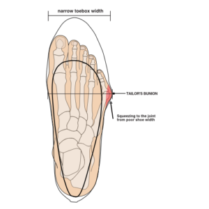 Ball of Foot and Toe Pain – NHS Forth Valley